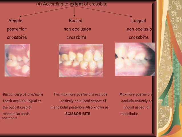posterior crossbite in primary and mixed dentition etiology and ...