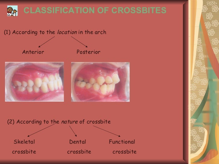 posterior crossbite in primary and mixed dentition etiology and mana…
