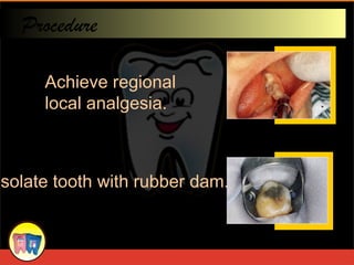 pulpectomy-pedo | PPT