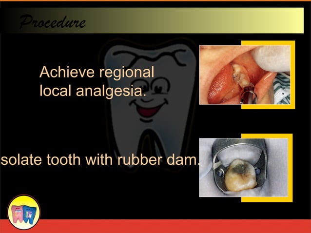 pulpectomy-pedo | PPT