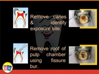 pulpectomy-pedo | PPT