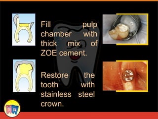 pulpectomy-pedo | PPT