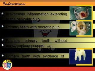 pulpectomy-pedo | PPT