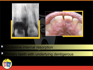 pulpectomy-pedo | PPT