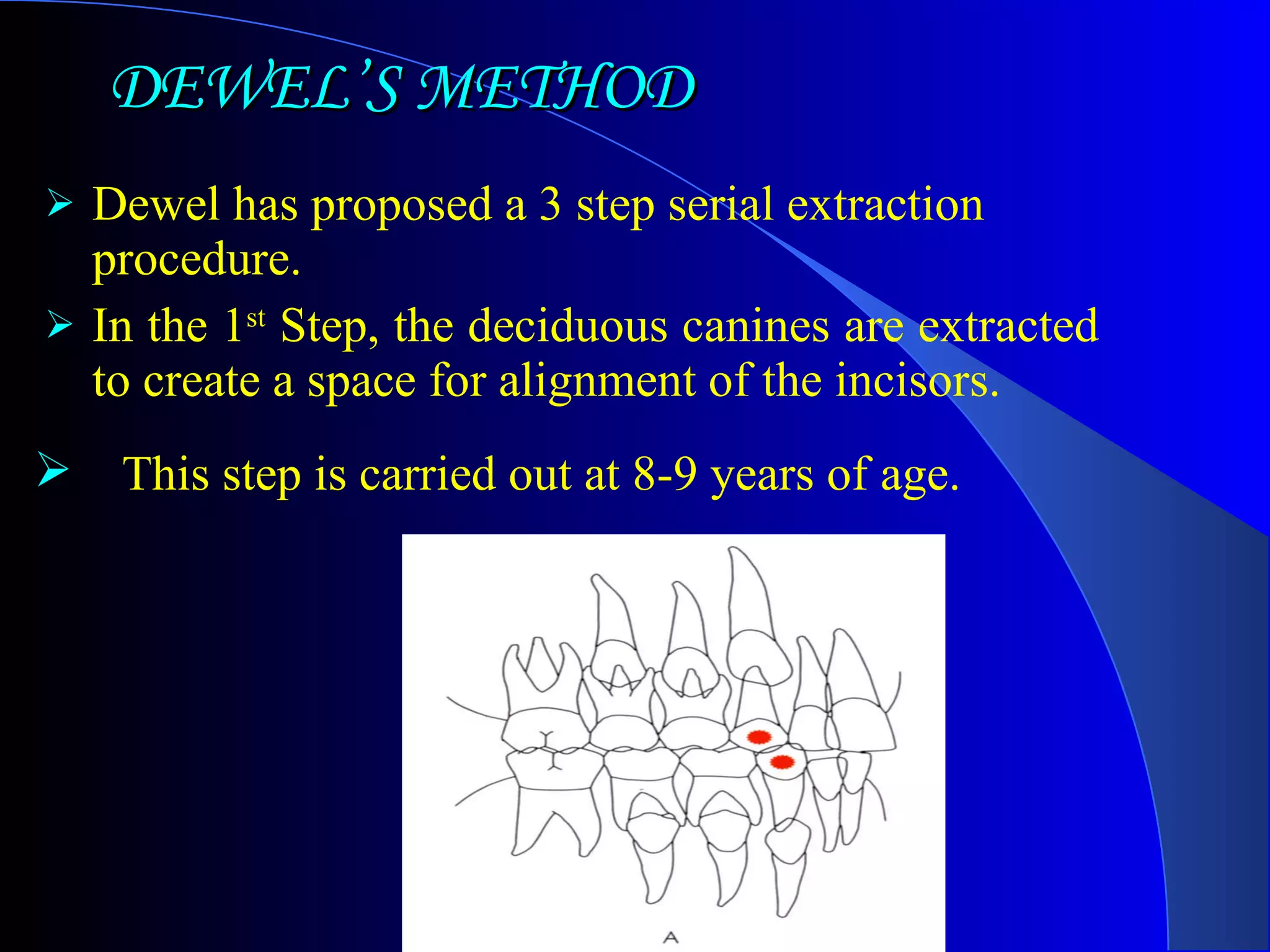 serial extraction | PPT | Dental Health | Diseases and Conditions