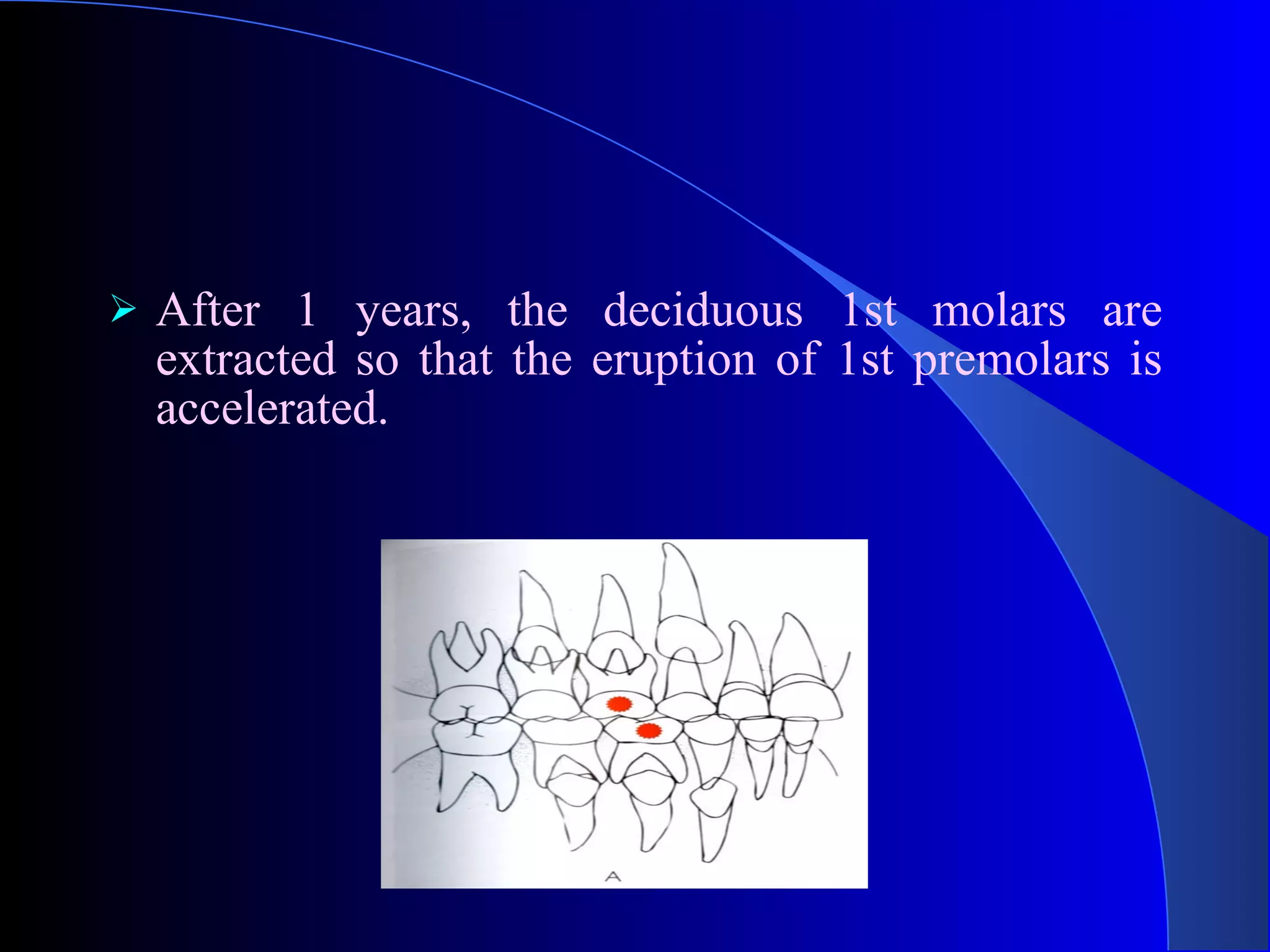 serial extraction | PPT
