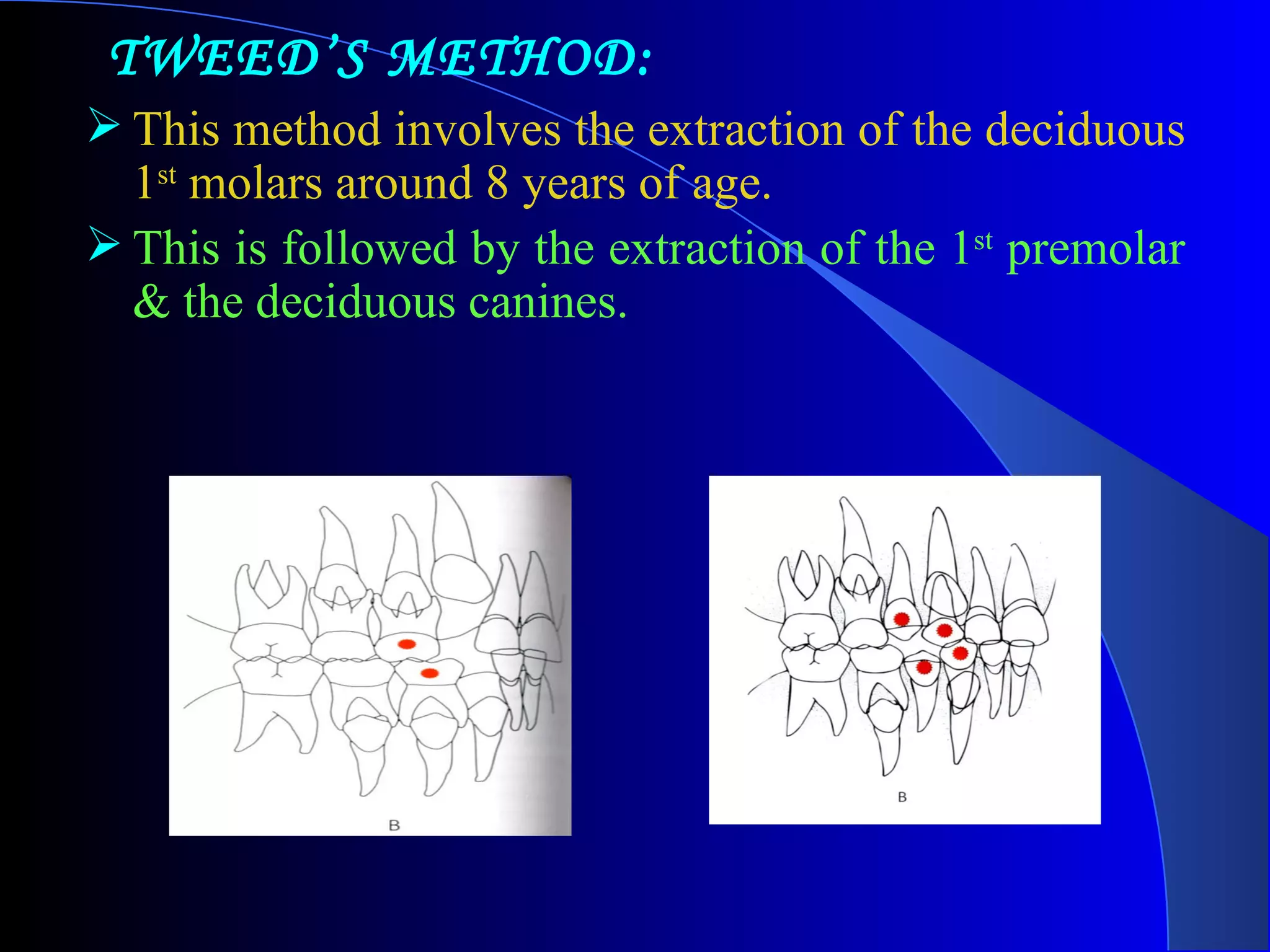serial extraction | PPT | Dental Health | Diseases and Conditions