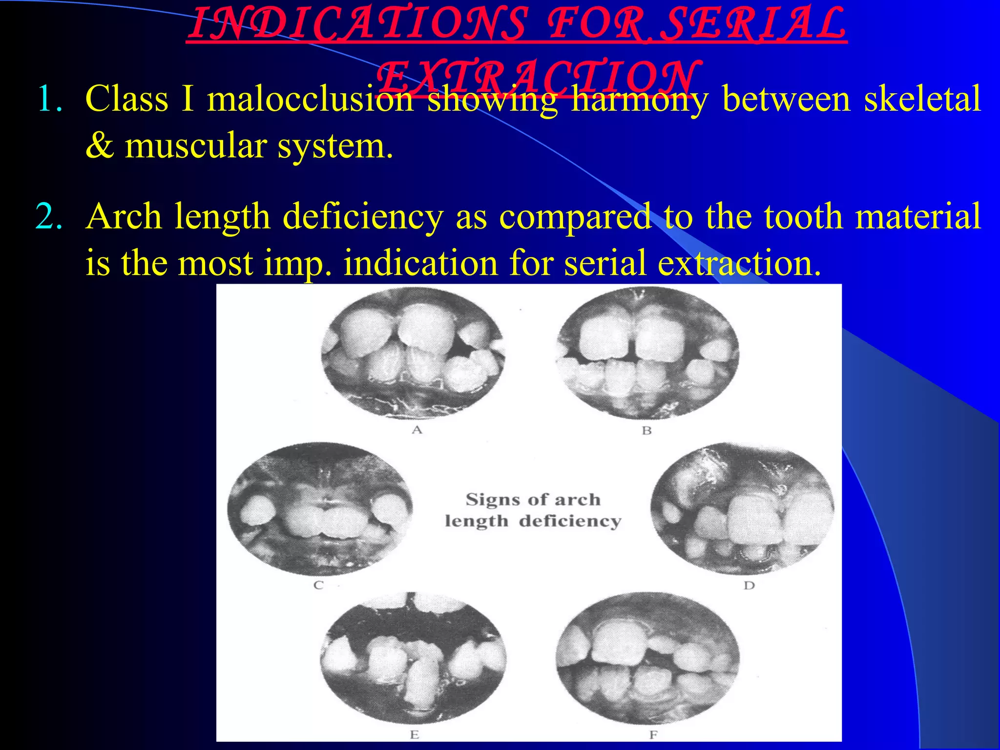 serial extraction | PPT