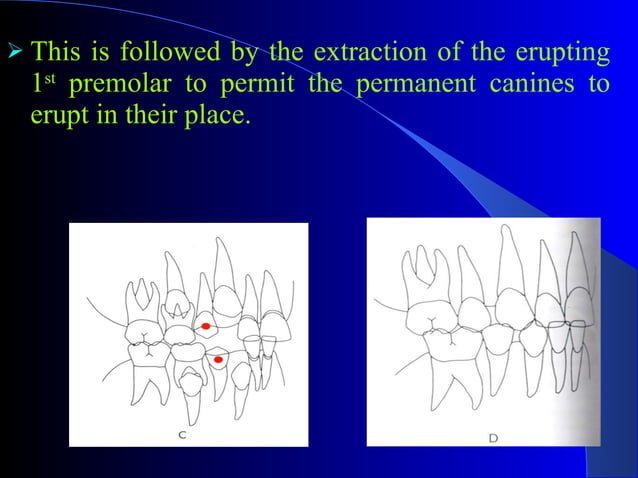 serial extraction | PPT | Dental Health | Diseases and Conditions