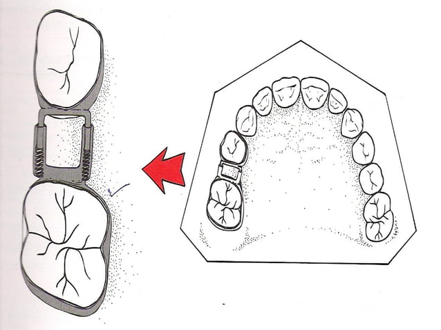space-regaining-pedo | PPT