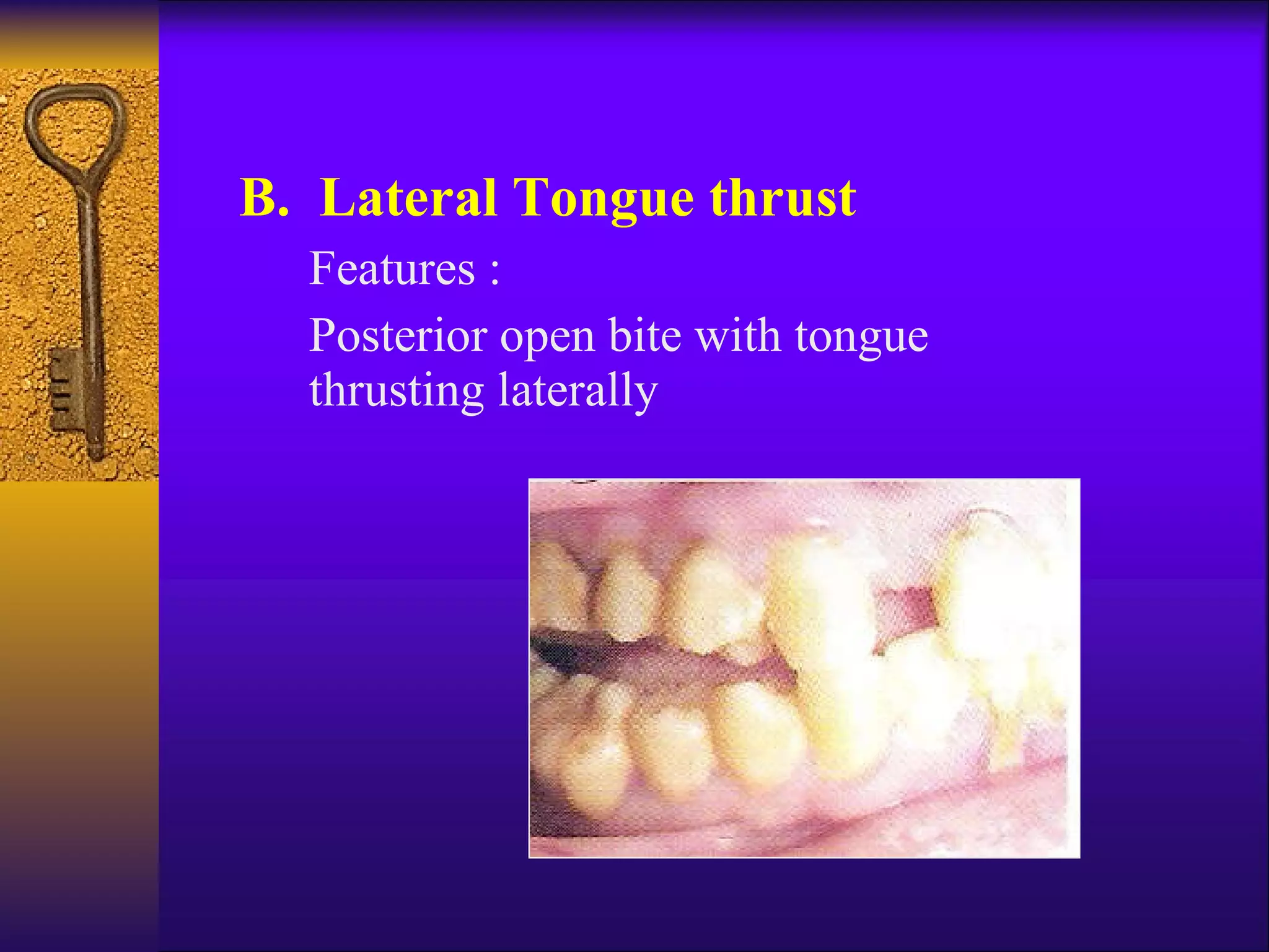 tongue-thrusting | PPT