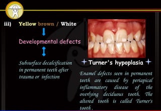 tooth-discolouration-pedo | PPT
