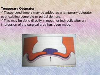 Tissue-conditioners | PDF