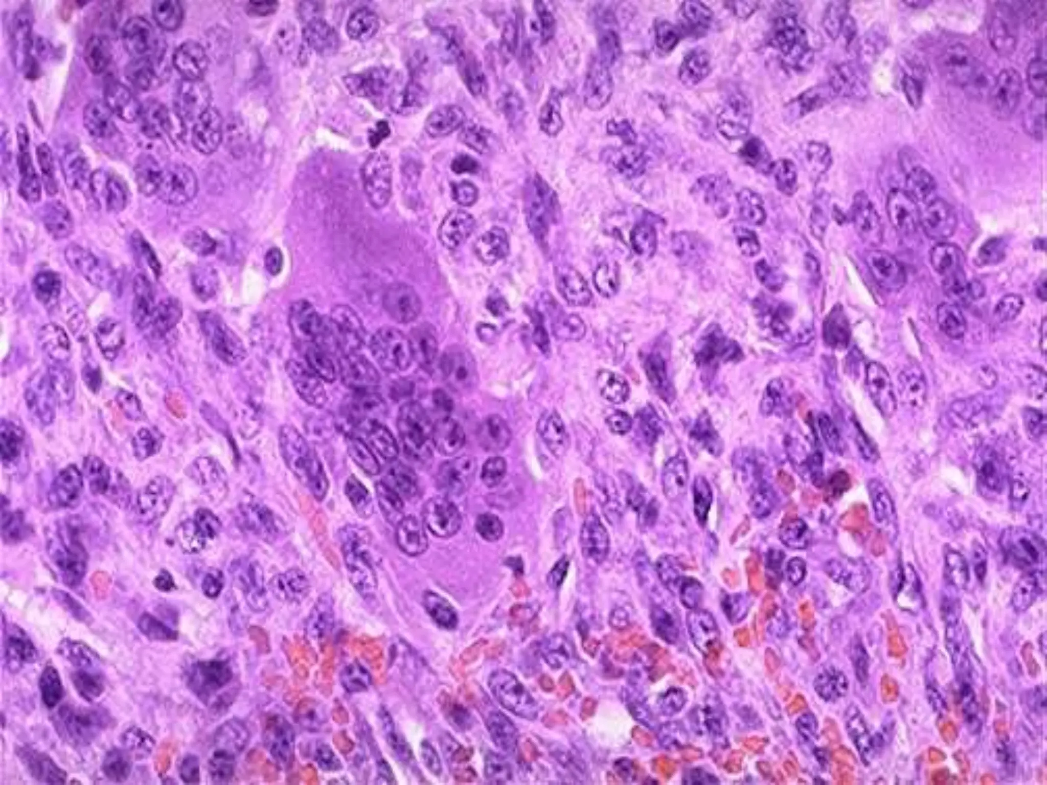 Bone Tumours Presentation Benign Malignant Ppt