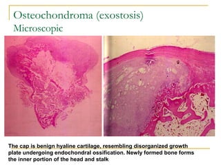 Bone Tumours presentation benign malignant.ppt
