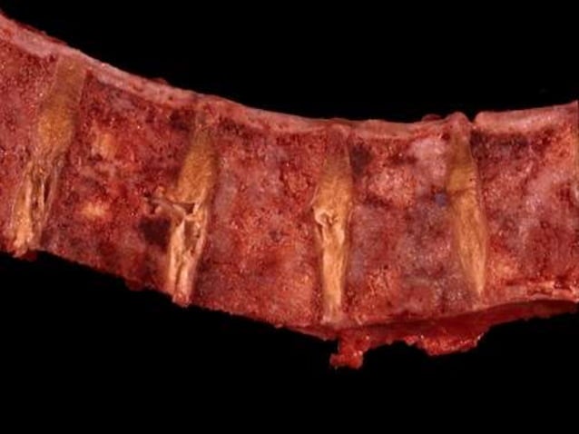 Bone Tumours Presentation Benign Malignant Ppt