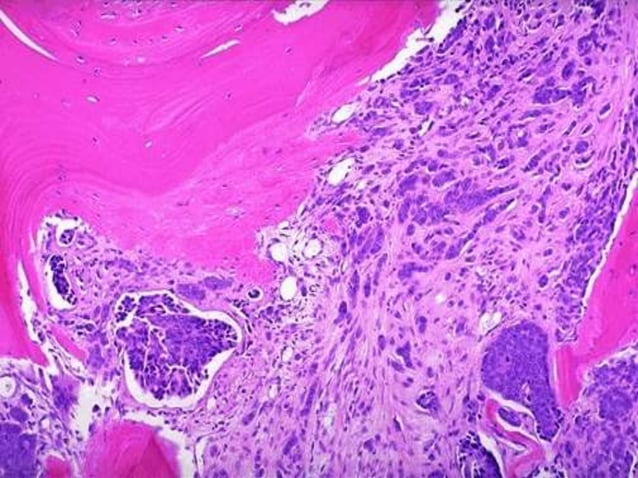 Bone Tumours Presentation Benign Malignant Ppt