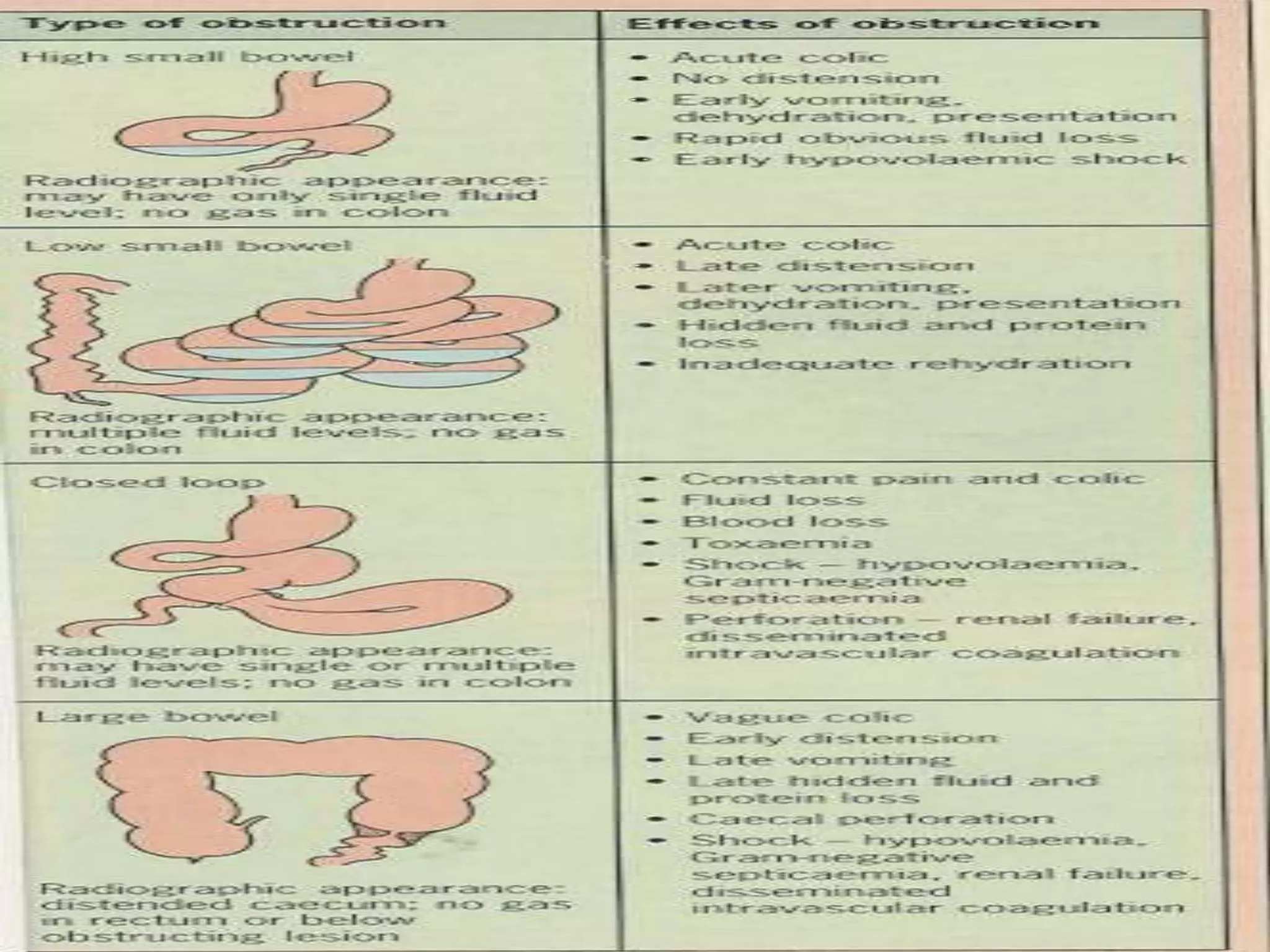 32987_INTESTINAL OBSTRUCTION(pbl)(teaching).ppt