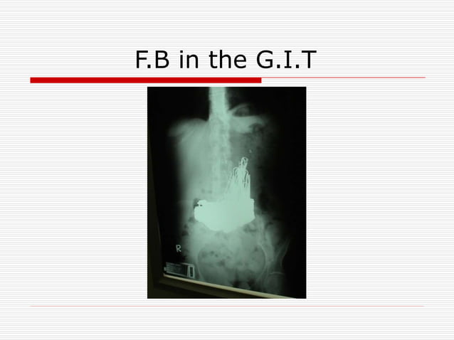 32987_INTESTINAL OBSTRUCTION(pbl)(teaching).ppt