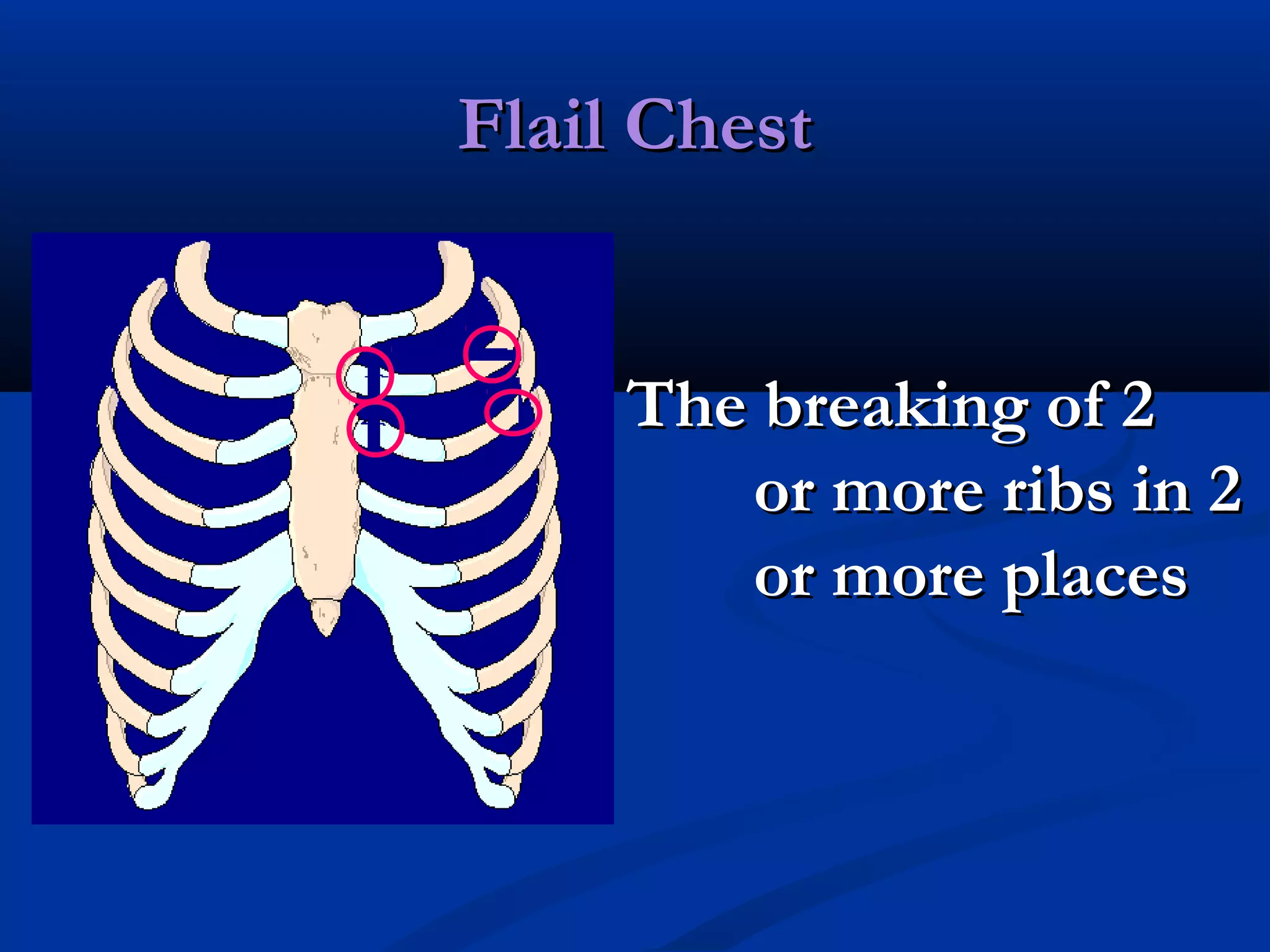 chest trauma management | PPT