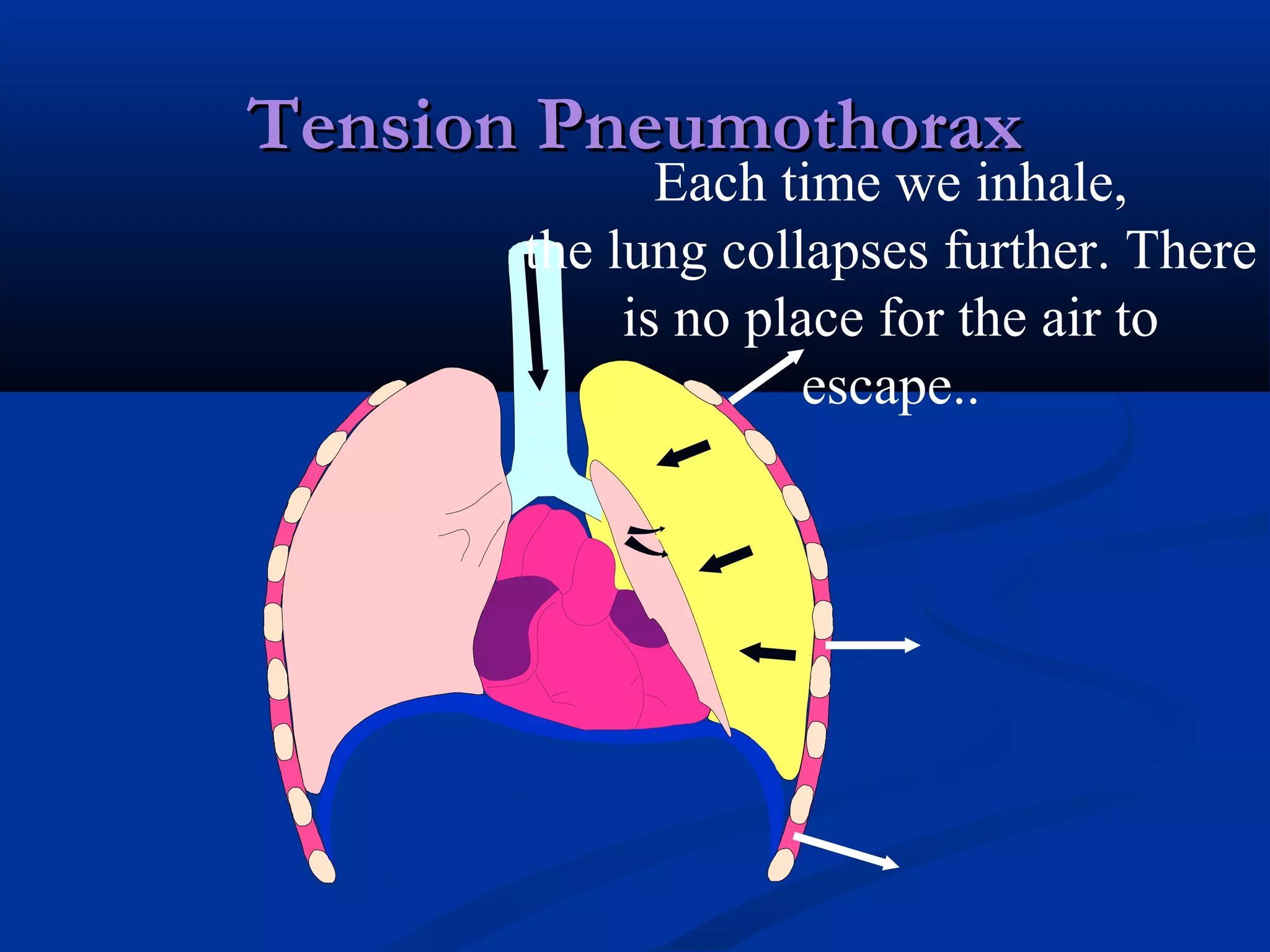 chest trauma management | PPT
