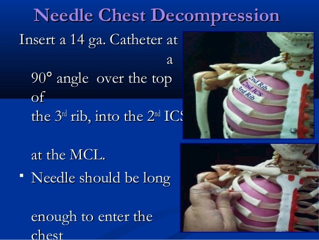 chest trauma management
