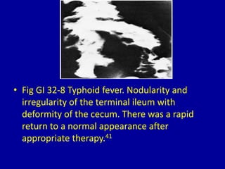 32 coned cecum | PPTX