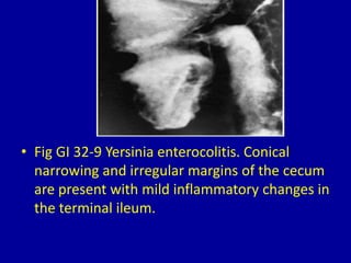 32 coned cecum | PPTX