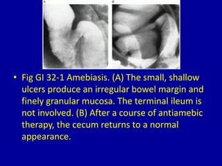 32 coned cecum | PPT