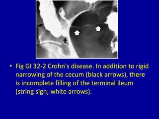 32 coned cecum | PPTX