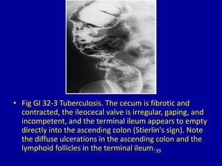 32 coned cecum | PPTX