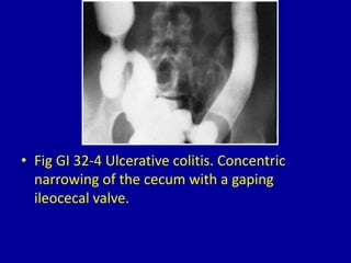 32 coned cecum | PPTX