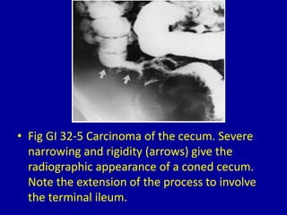32 coned cecum | PPT