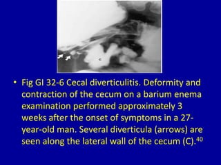 32 coned cecum | PPTX