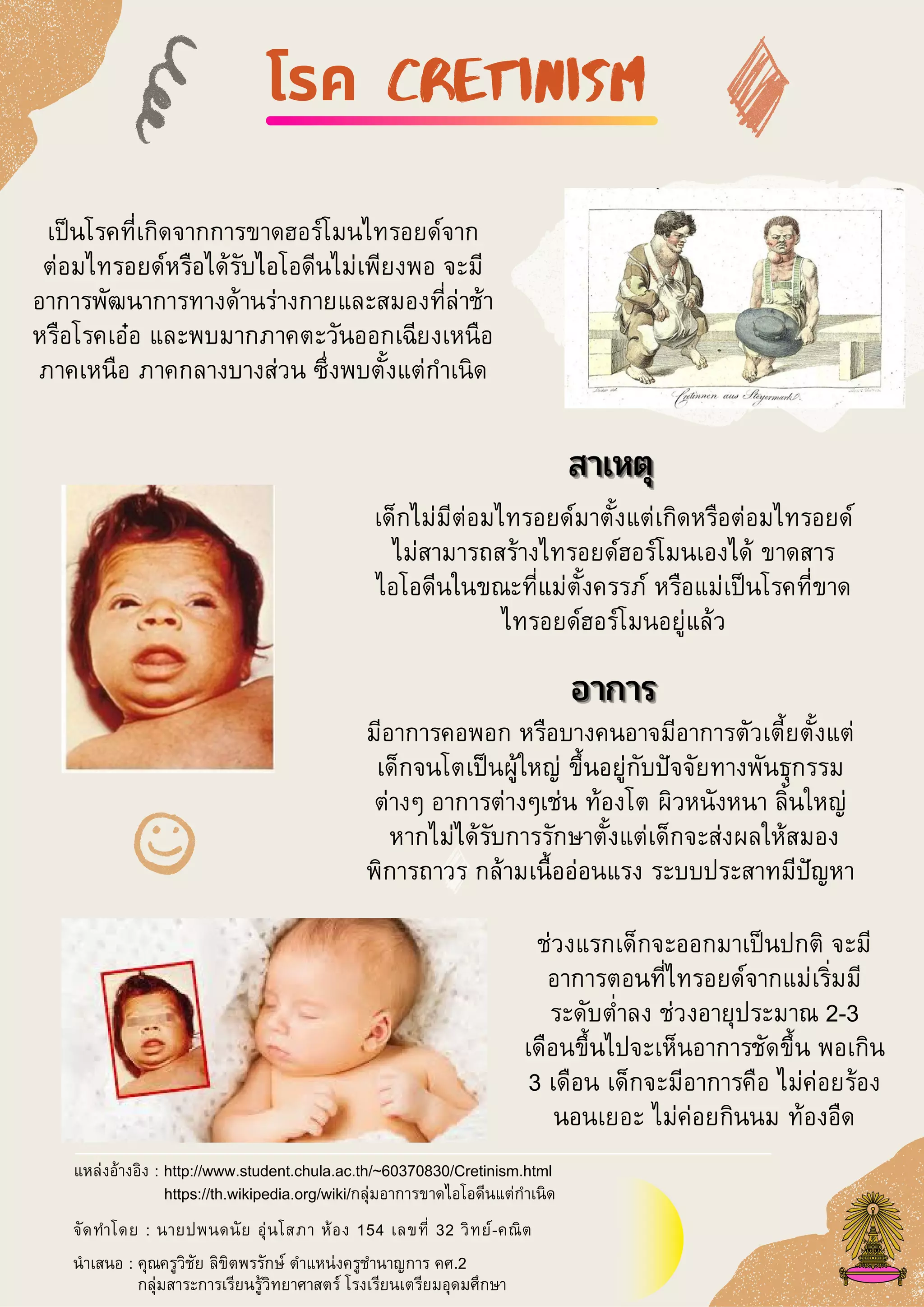 32 ปพนดนัย อุ่นโสภา โรค cretinism | PDF