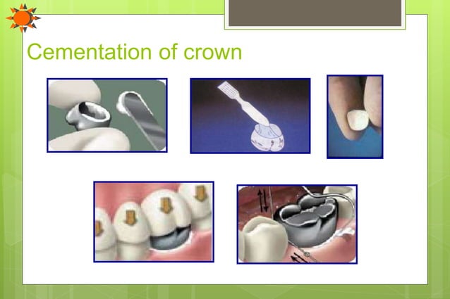 Crowns in pediatric dentistry.ppt