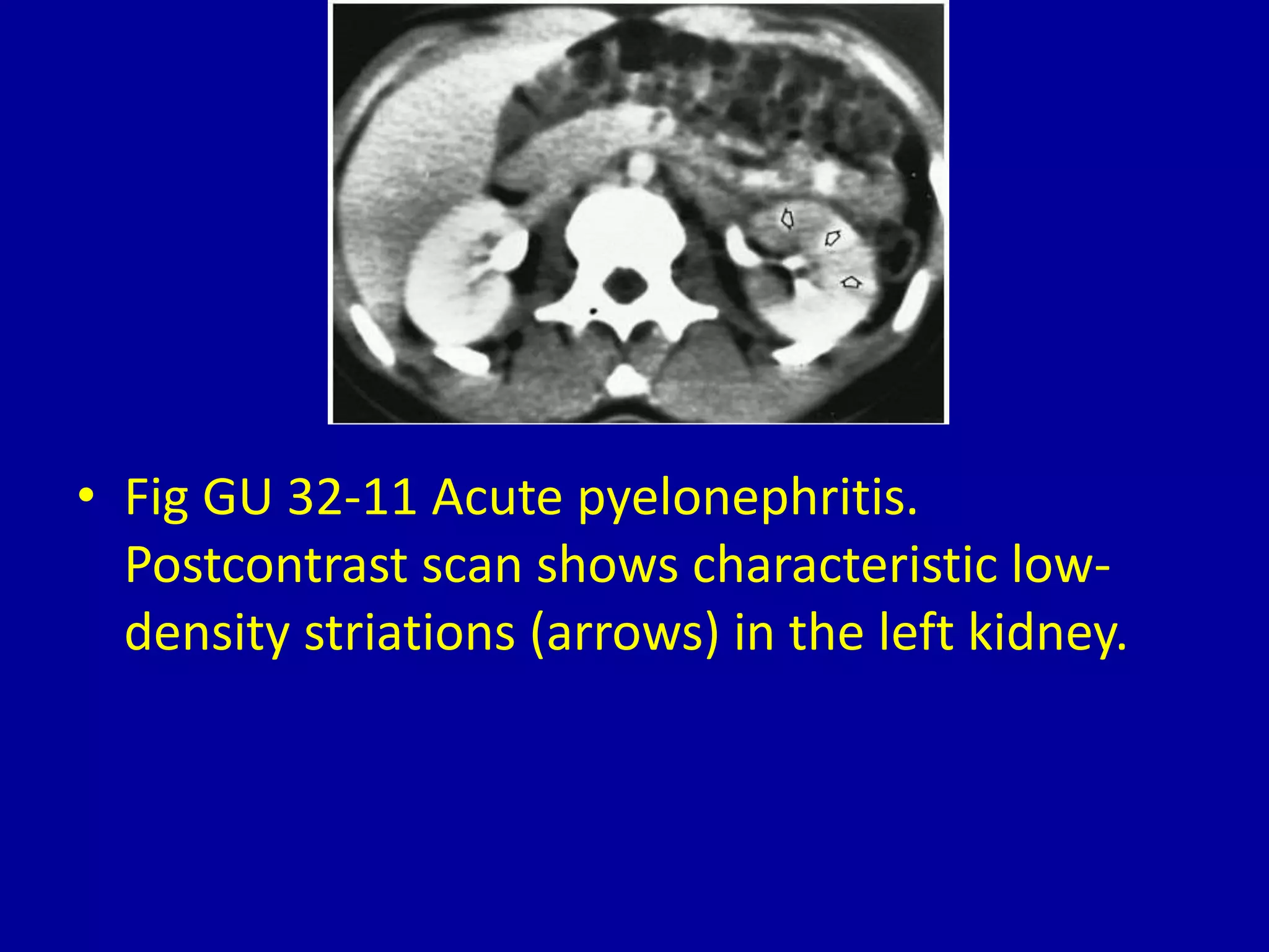 32 focal solid renal masses on computed tomography | PPTX