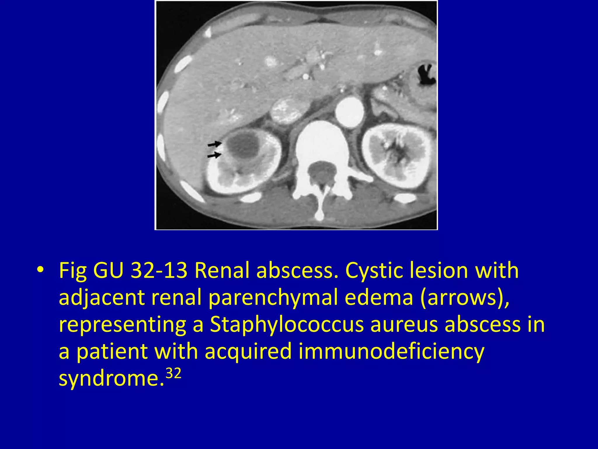 32 focal solid renal masses on computed tomography | PPTX