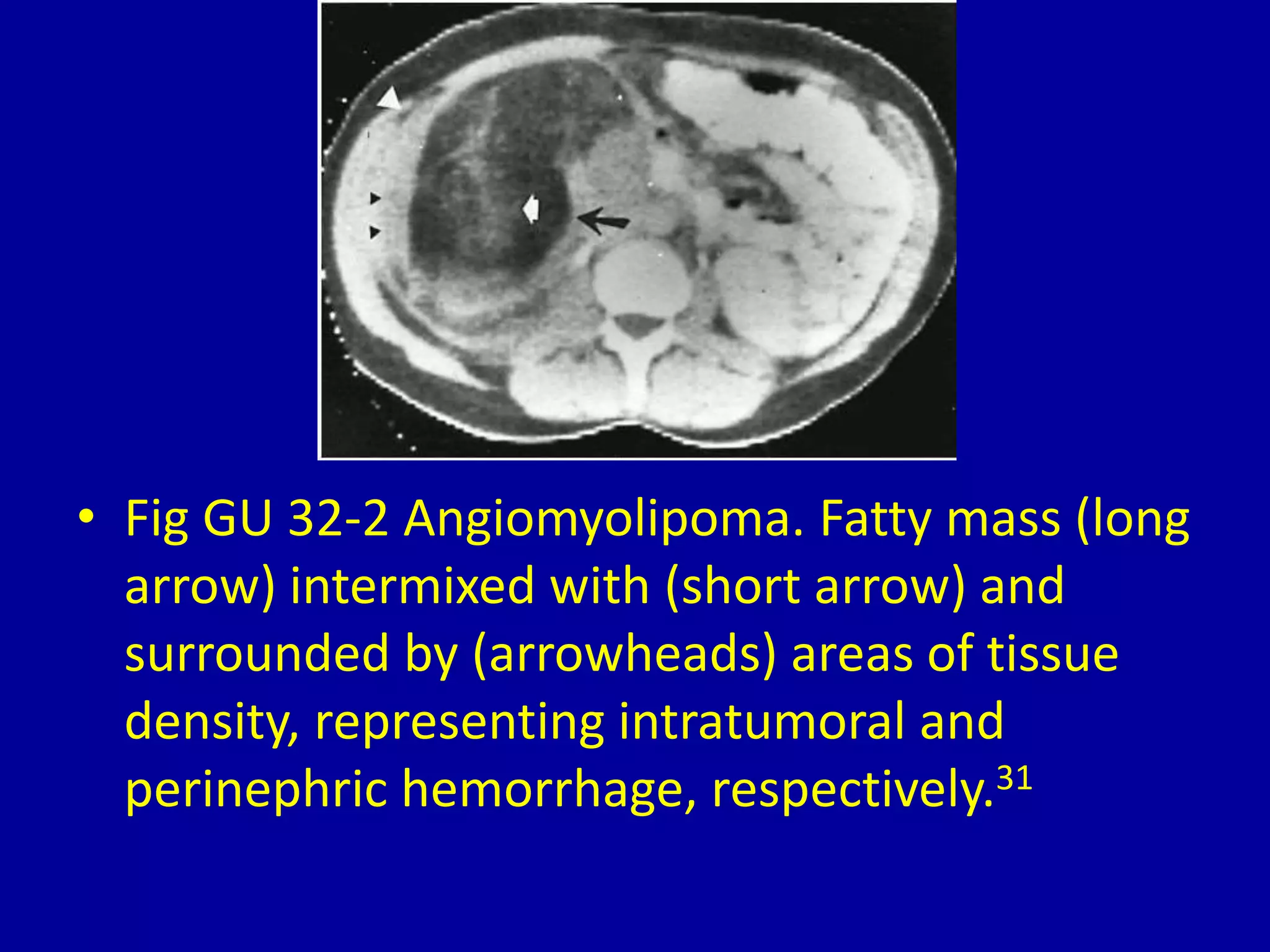 32 focal solid renal masses on computed tomography | PPTX