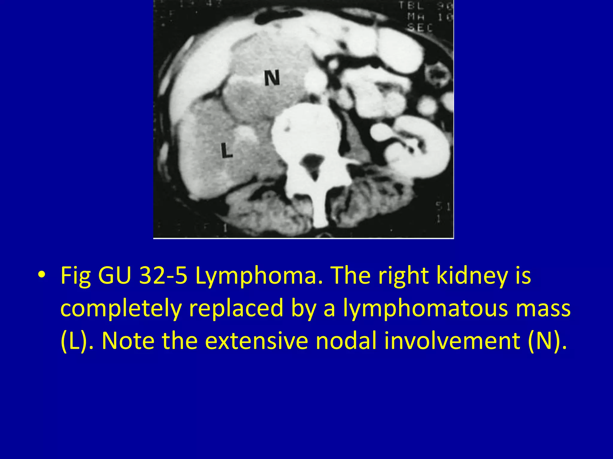 32 focal solid renal masses on computed tomography | PPTX