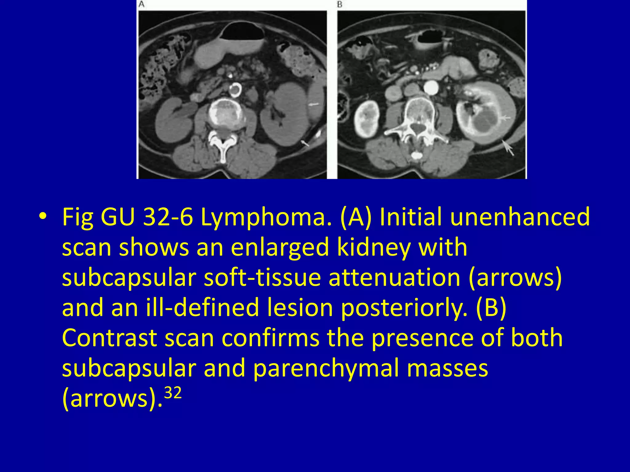 32 focal solid renal masses on computed tomography | PPTX