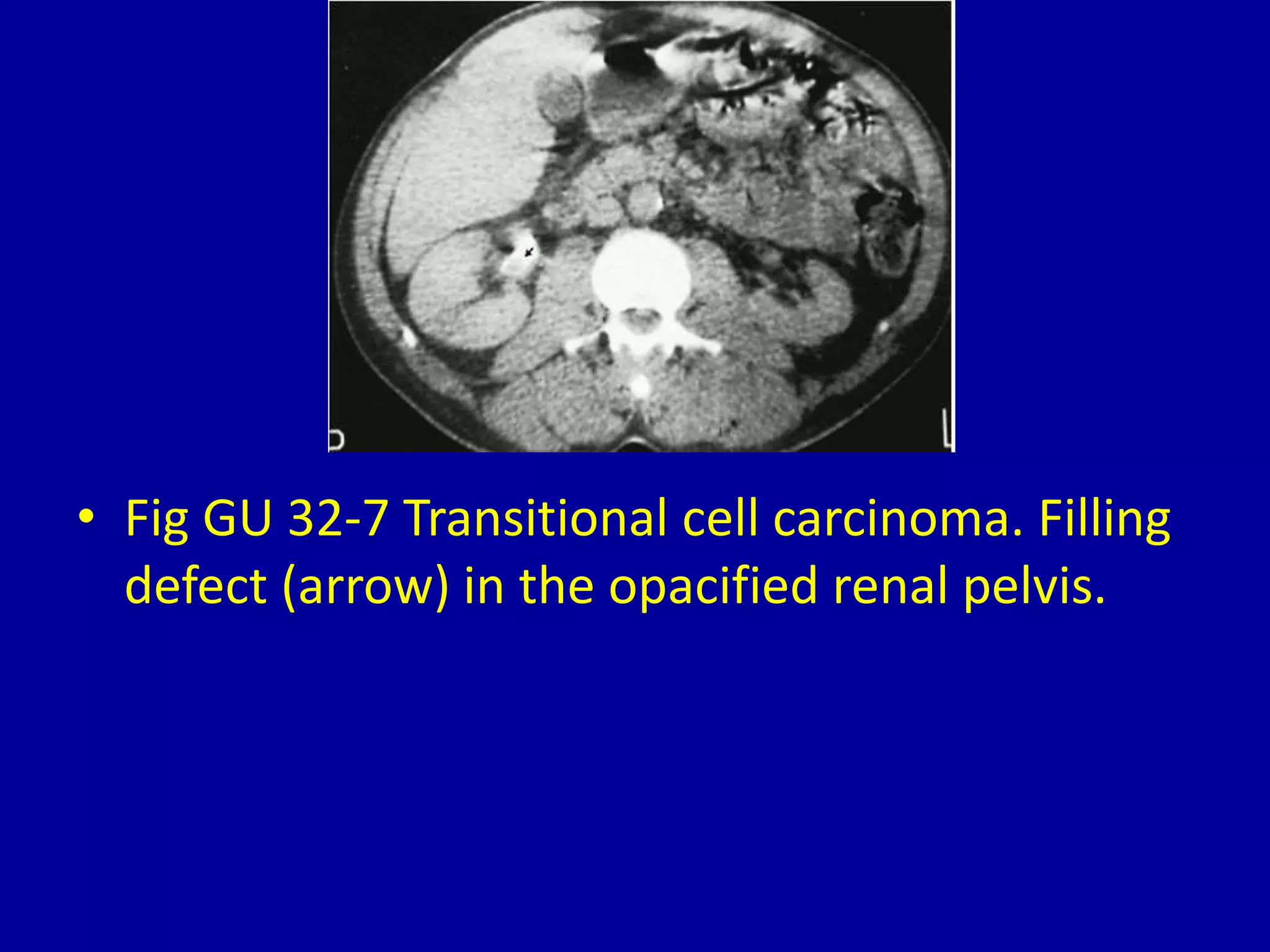 32 focal solid renal masses on computed tomography | PPTX
