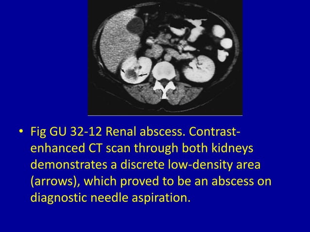 32 focal solid renal masses on computed tomography | PPT