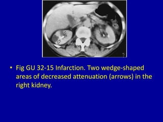 32 focal solid renal masses on computed tomography | PPTX