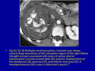 32 focal solid renal masses on computed tomography | PPTX