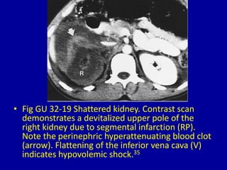 32 focal solid renal masses on computed tomography | PPTX