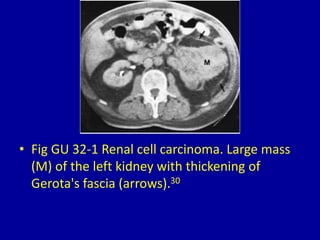 32 focal solid renal masses on computed tomography | PPTX