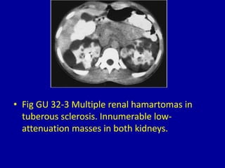 32 focal solid renal masses on computed tomography | PPTX
