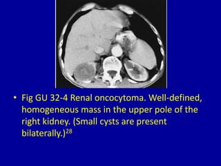 32 focal solid renal masses on computed tomography | PPTX