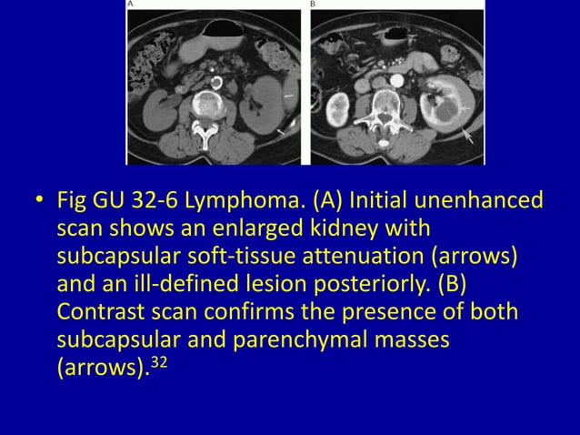32 focal solid renal masses on computed tomography | PPT